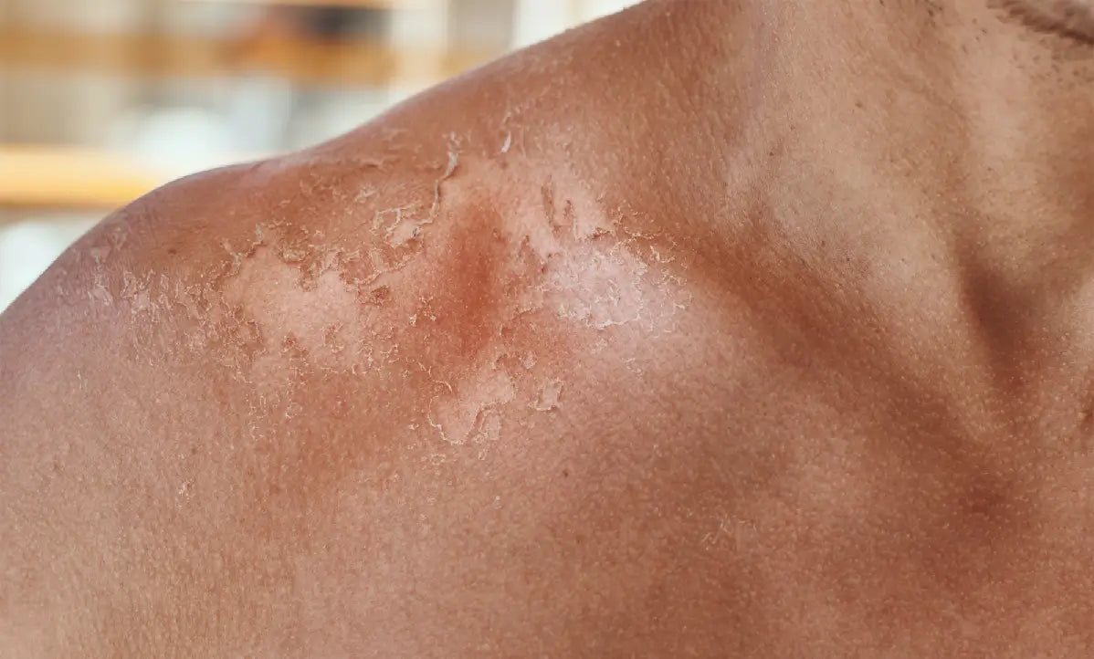 How to Treat Skin Burns from Skincare Products or Peels – CelluHeal